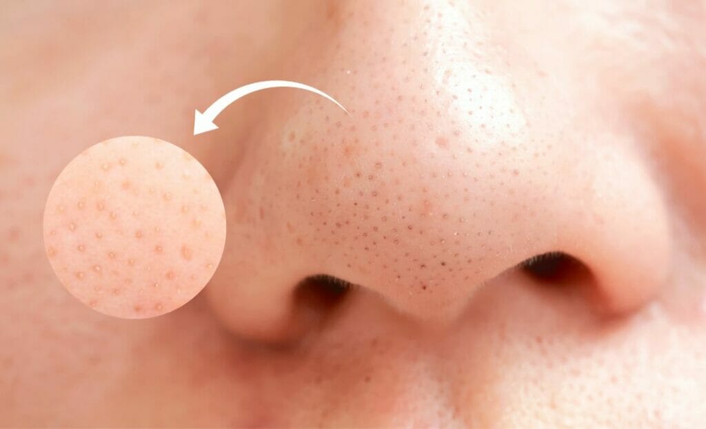 Unlock the Secrets to Clear Skin: How to Banish Sebaceous Filaments for ...