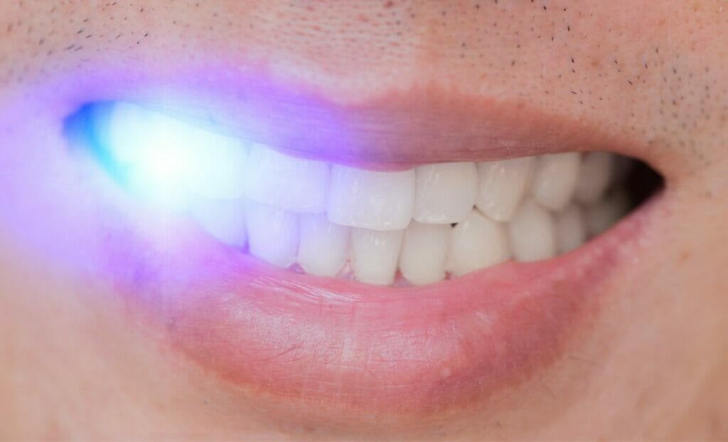 Unlock Your Brightest Smile with HiSmile: The Ultimate Teeth Whitening ...